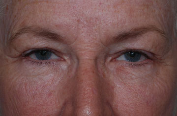 Lateral Canthopexy Before After